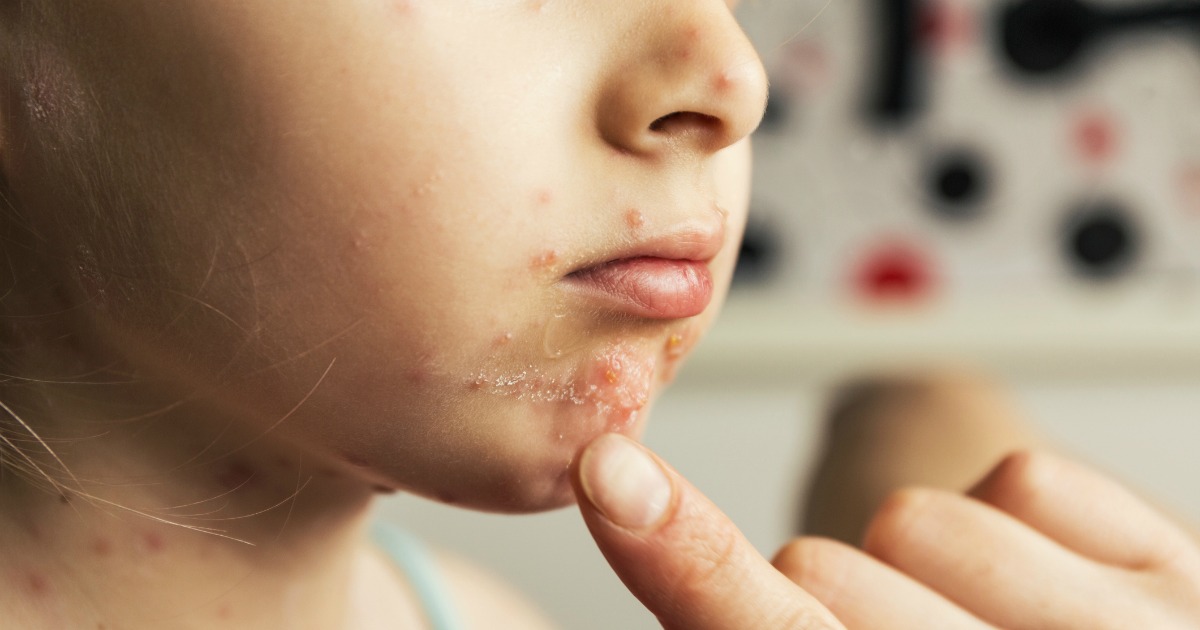 Treatment Options For Impetigo - HealthPrep.com