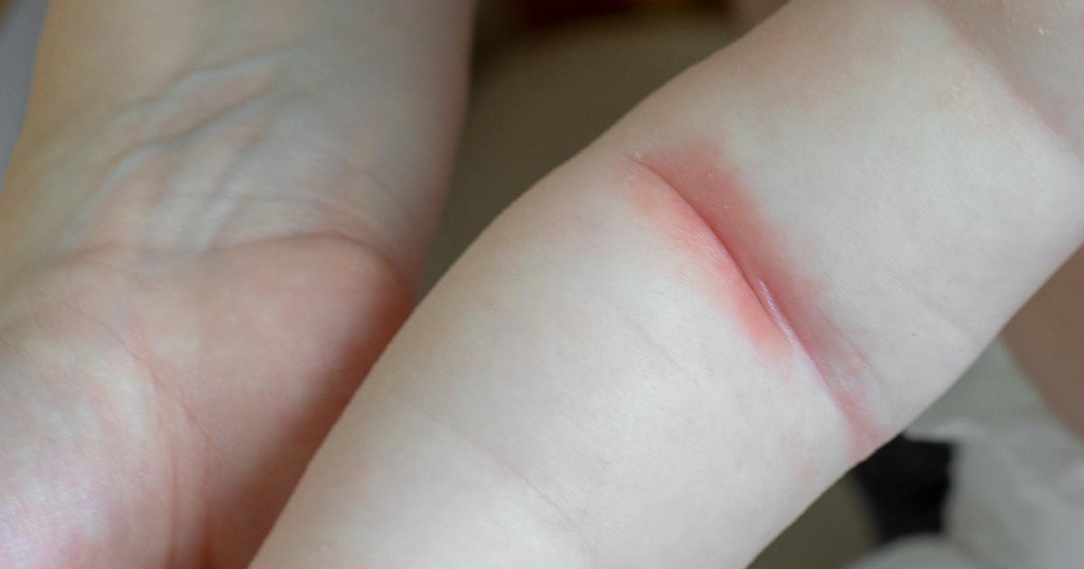 Guide To The Symptoms And Types Of Heat Rash - HealthPrep.com