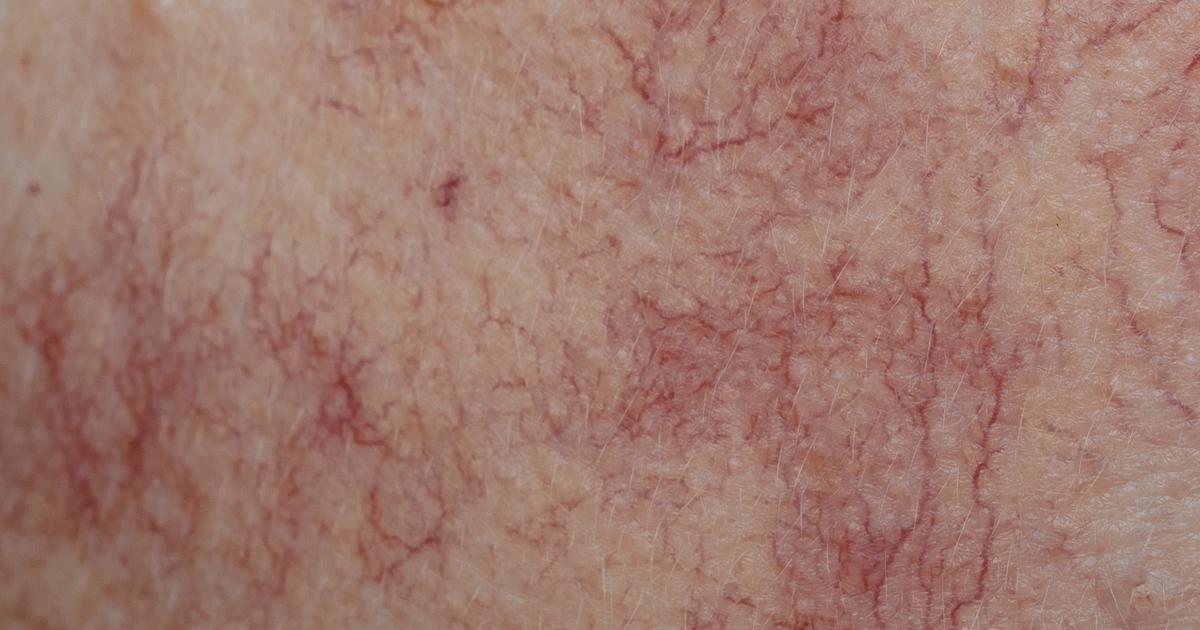 Guide To Treating And Preventing Broken Blood Vessels On The Face ...