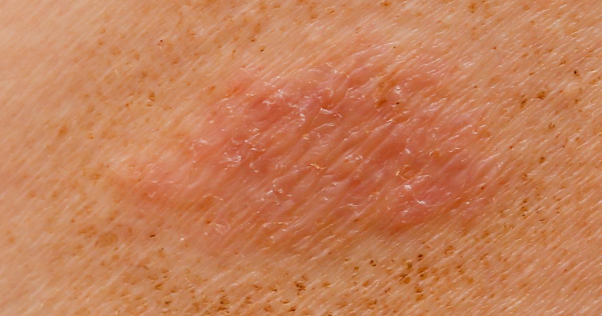 Guide To The Symptoms Of Ringworm - HealthPrep.com