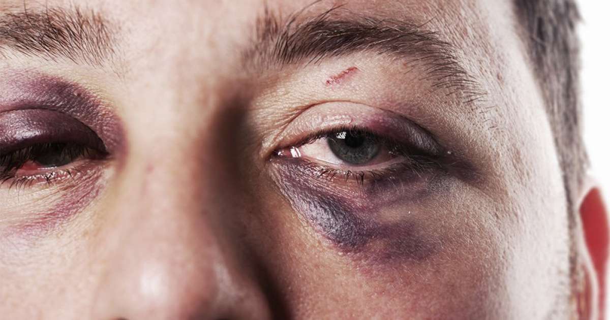 Prevention And Treatment Options For A Black Eye - HealthierHer.com