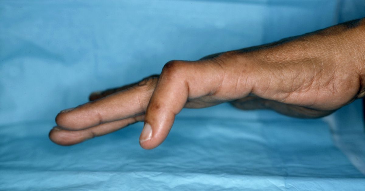 How To Treat Boutonnière Deformity - HealthierHer.com
