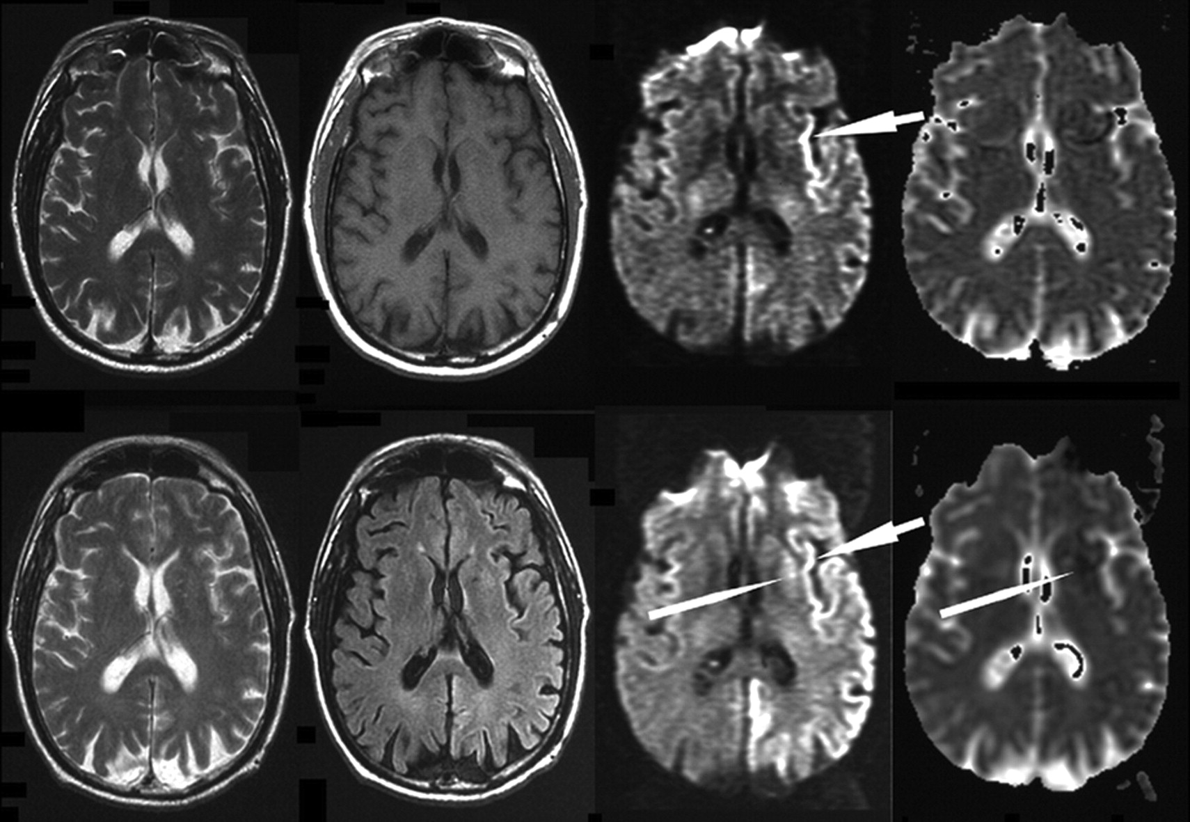 Warning Signs Of Creutzfeldt-Jakob Disease - HealthierHer.com