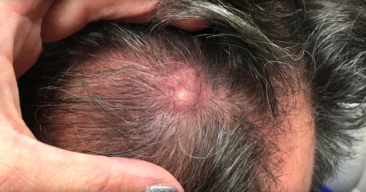 Ways To Identify A Pilar Cyst - HealthierHer.com