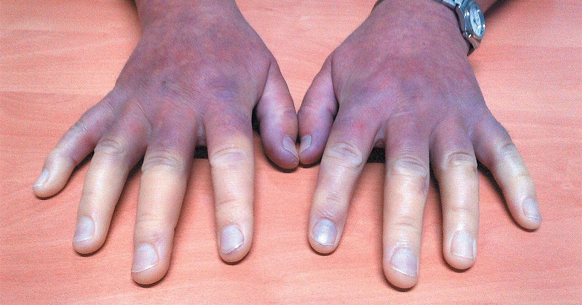 Ways To Treat Raynaud's Disease - HealthierHer.com