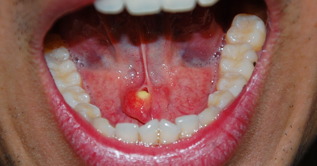 How To Treat A Salivary Gland Stone - HealthierHer.com