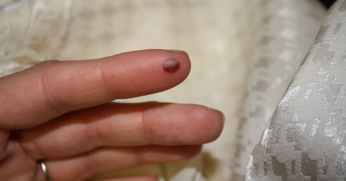 What Causes Blood Blisters? - HealthierHer.com