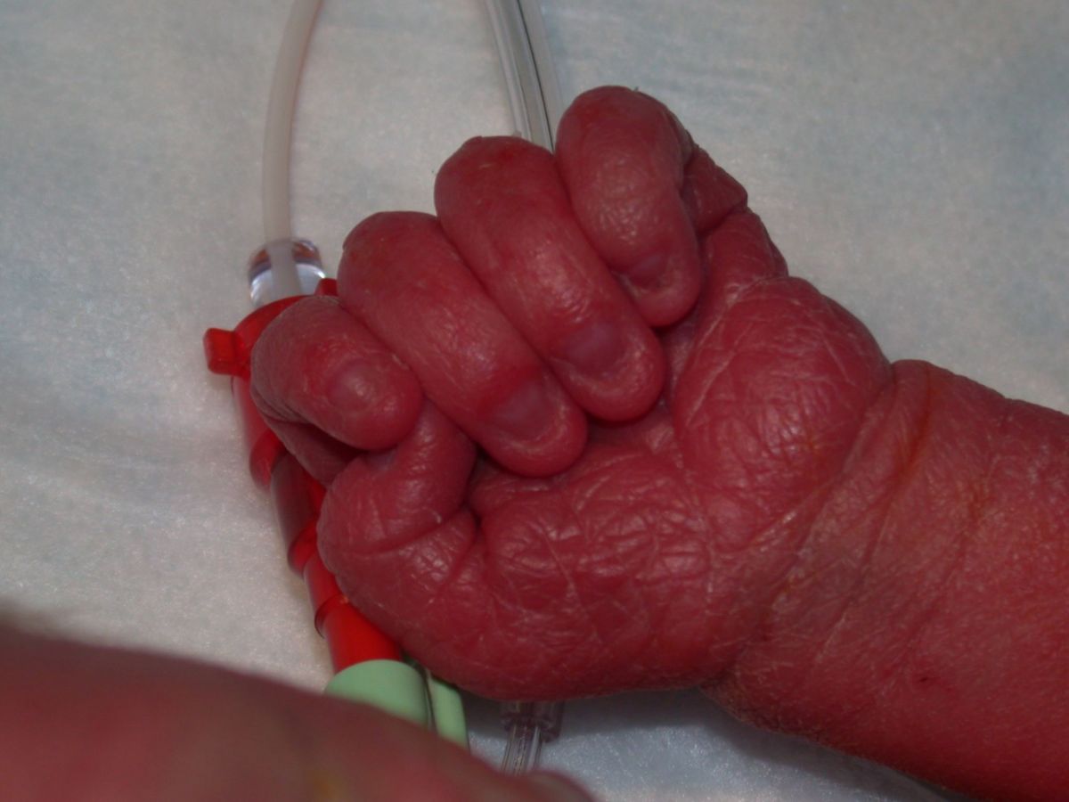 What Are The Symptoms Of Hay-Wells Syndrome? - HealthierHer.com