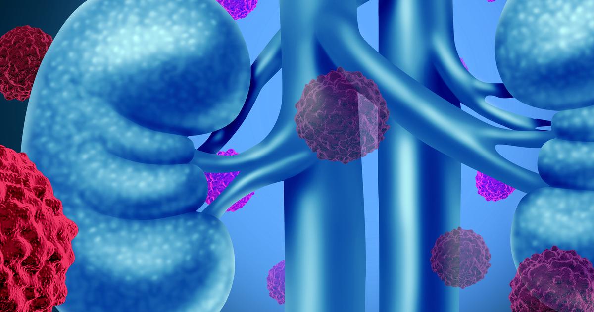 Guide To The Major Types Of Kidney Cancer - HealthierHer.com