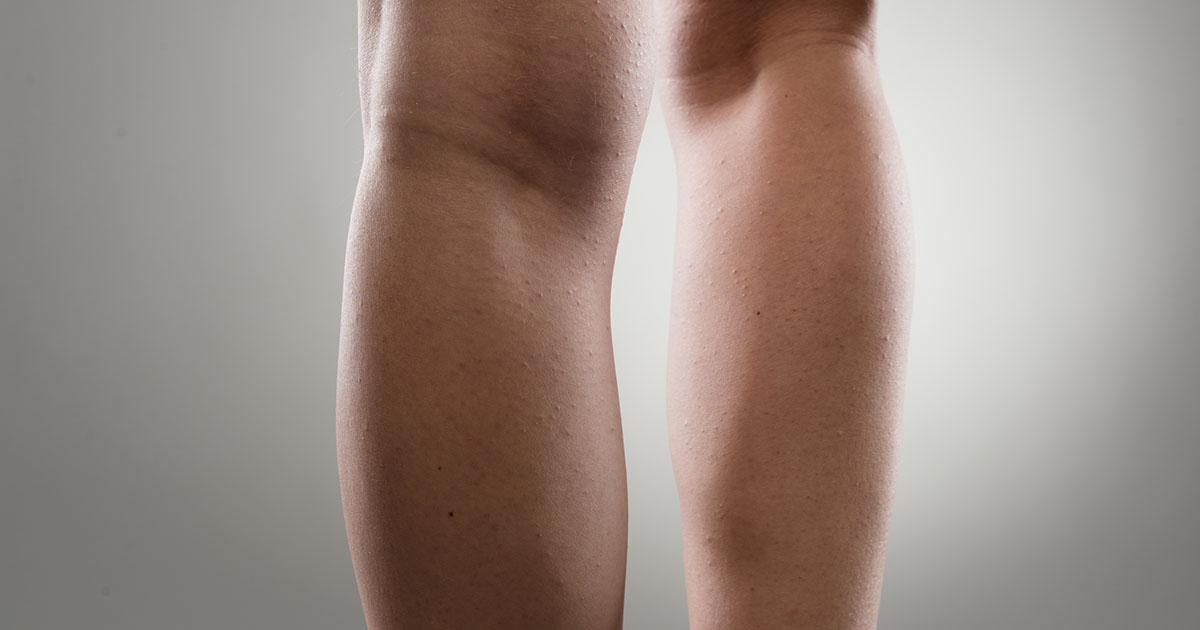 Symptoms Of Hypervolemia - HealthierHer.com